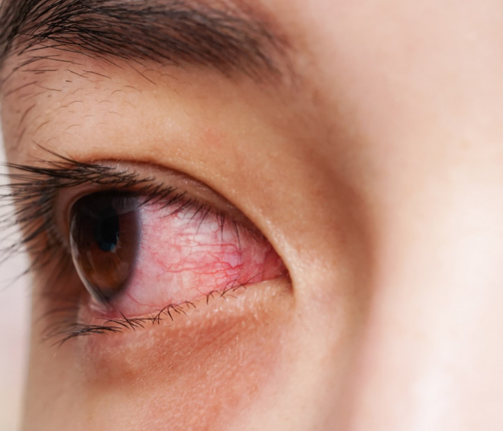 Dry Eye Treatment in Chicagoland | Rosin Eyecare